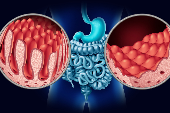 Enfermedad de Crohn: Todo lo que necesitas saber | Blog eColón